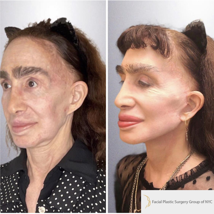 Deep Plane Facelift Before and After Photos