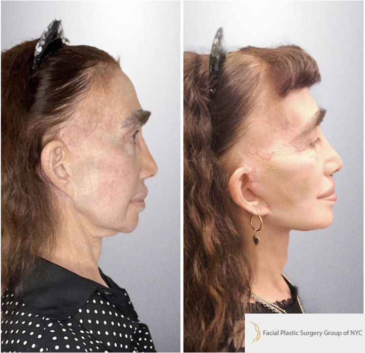 Deep Plane Facelift Before and After Photos
